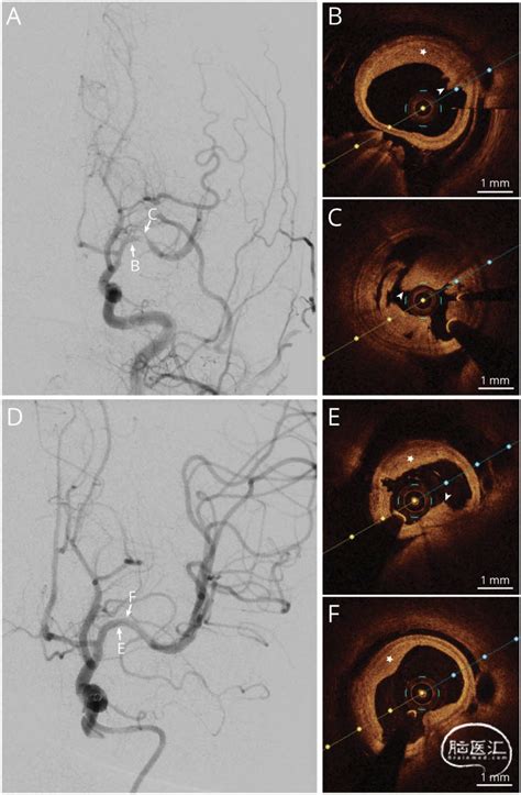 Neurology：取栓术中光学相干断层扫描识别卒中病因 脑医汇
