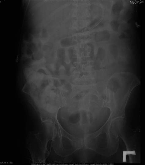 Pseudomembranous Colitis X Ray