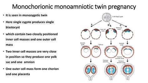 Anatomy Of Twin Pregnancy Pptx