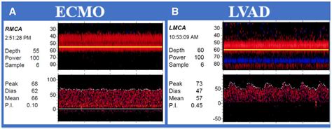 Transcranial Doppler Waveforms Obtained From Patients With Continuous