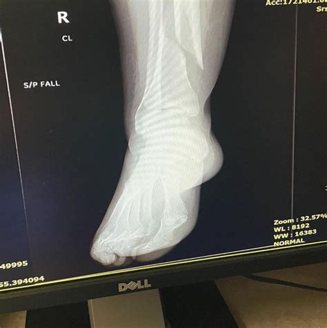 One Week Post Op Tib Fib R Orif