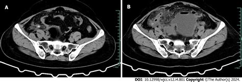 Endoscopic Retrograde Appendicitis Treatment For Periappendiceal Abscess A Case Report