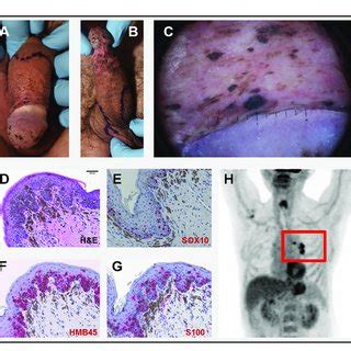 A B Clinical Pictures At First Visit Multiple Slightly Palpable Download Scientific