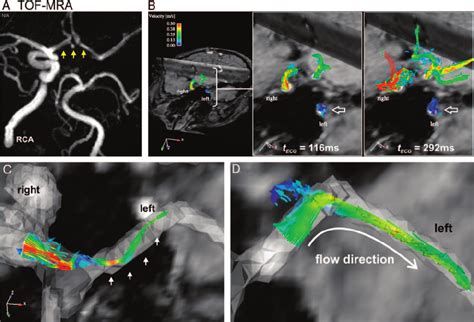 Time Resolved 3d Particle Trace Visualization For A Patient With