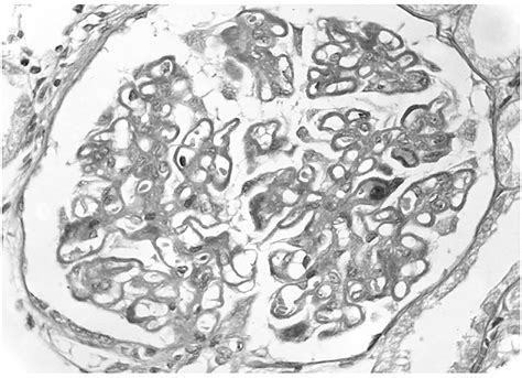 Diffuse Proliferative Glomerulonephritis Em