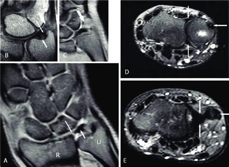 The Normal Components Of The Tfcc On Coronal Fs Pd Wi A Coronal