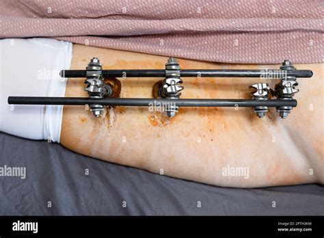 Top View Of External Fixation Device On Hip And Pelvic In Patient With Pelvic Fracture Focus On