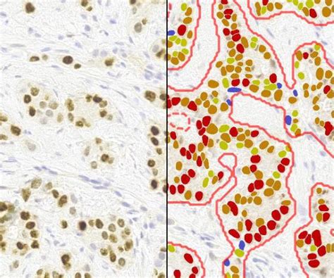Breast Pr Ai For Breast Cancer Sample Analysis