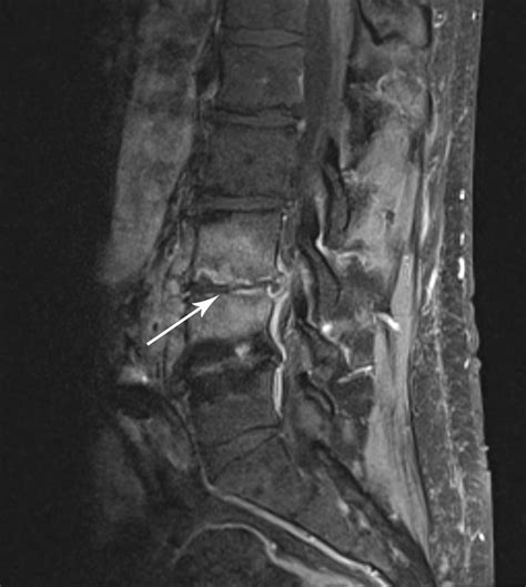 Magnetic Resonance Imaging Mri Of The Lumbar Spine Demonstrating