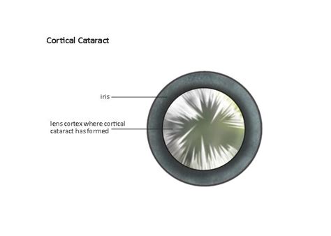 Cortical Cataract