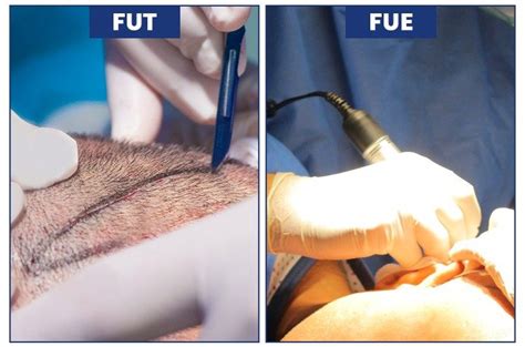 Understanding The Scalp Muscle Anatomy Function And Health Benefits