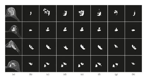Qualitative Analysis Of 2d Dce Mri Breast Segmentation Using Both Download Scientific Diagram