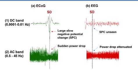 Real Time Non Invasive Imaging And Detection Of Spreading Depolarizations Through Eeg An Ultra