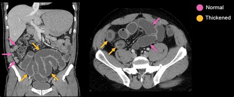 Abdominal Ct Small Intestine • Litfl • Radiology Library