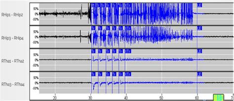 Dual Target Amygdalohippocampal Thalamic Low Frequency Responsive