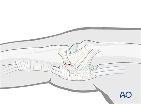 Reduction With Or Without Joint Transfixation For Dislocation Of The