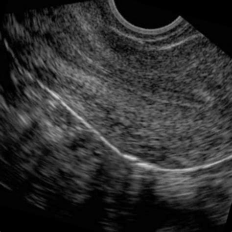 Pcos Best Dataset With 0 Duplicate Image Kaggle Pcos Best Dataset With 0 Duplicate Image Kaggle