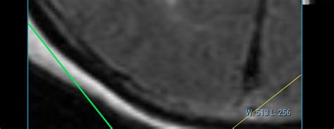 Interactive Slice Intersections · Issue 5544 · Slicerslicer · Github