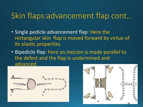Flaps In Surgery Pptx