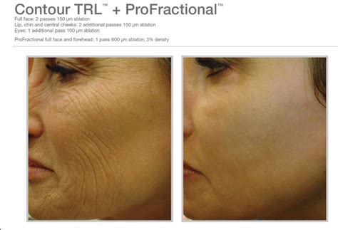 Profractional Laser In Beavercreek Puremd