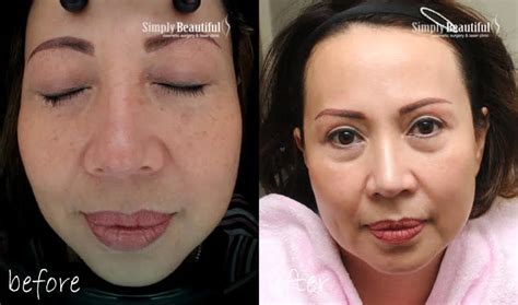 Laser Skin Whitening Rejuvenation Dr Peter Kim Surgery Skin