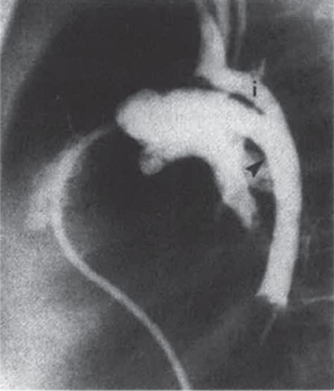 Patent Arterial Duct Thoracic Key