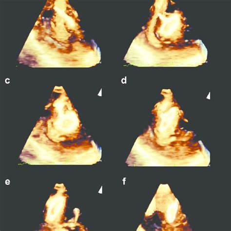 Procedure Of The Operation A The Echo Probe Is Applied Directly To Download Scientific