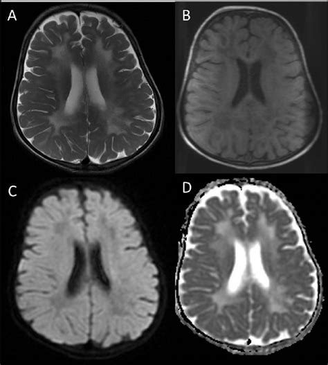 A Axial T2 Weighted Image Showing Diffuse White Matter Hyperintensity Download Scientific