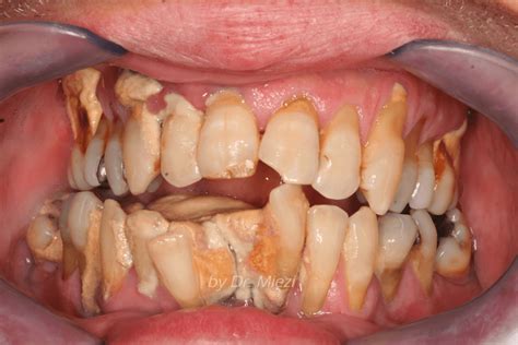 Most Severe Case Of Calculus I Treated Read The Story Behind The Case Periohome