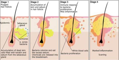 Acneiform And Verrucous Lesions Flashcards Quizlet