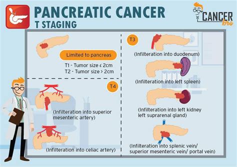 Pancreatic Cancer Tnm Staging Explained Videos Infographic In Easy