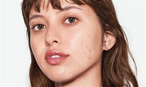 Could This Be An Answer To Your Blemish Prone Skin The Uk S Number Dermatologist Recommended