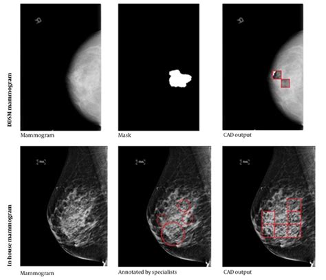 Microcalcification Detection In Mammograms Using Deep Learning