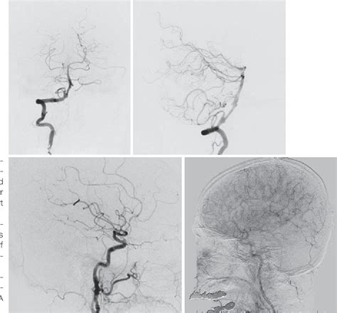 Figure From Vertebral Artery Stenosis As A Cause Of Headache And Convexity Subarachnoid