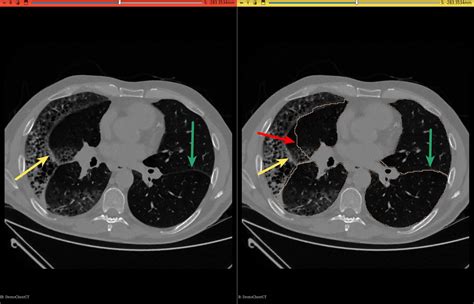 Improve Total Segmentator Lung Lobes Masks Support 3d Slicer Community