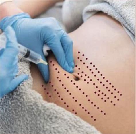 Lipodissolve Injections Botoxd Beauty Co