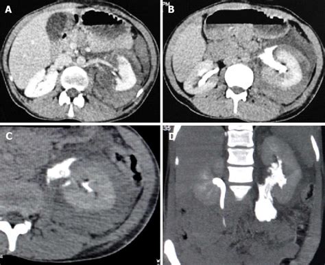 Renal Trauma Grading