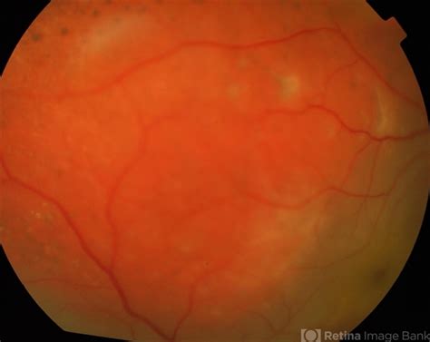 Diffuse Choroidal Hemangioma Retina Image Bank