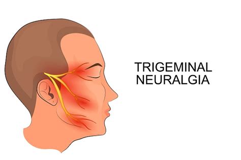 Patofisiologi Trigeminal Neuralgia Alomedika