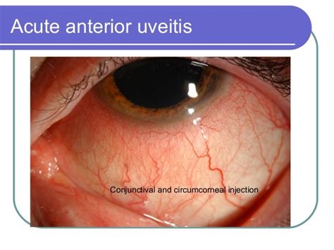 Iritis Vs Uveitis