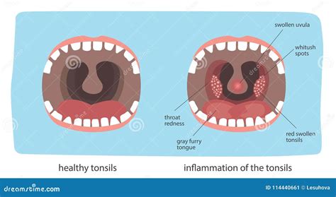 Healthy Tonsil Diagram