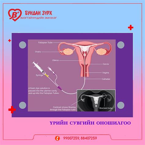 👉 Үрийн хоолойн шалтгаант Ш Булган эмчийн зөвлөгөө