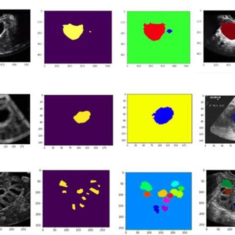 Segmentation Of Cyst Using The Watershed Algorithm Download Scientific Diagram