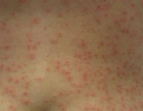 Pseudomonas Folliculitis A Bacterial Folliculitis That