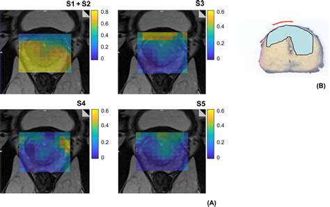 A Multivariate Curve Resolution Analysis Of Multicenter Proton