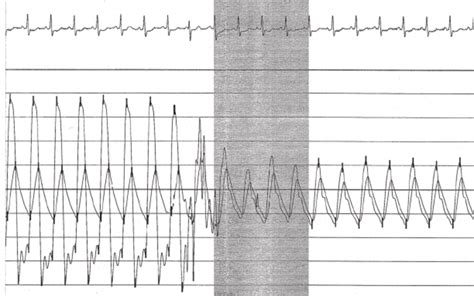 Invasive Assessment Of Aortic Stenosis Simultaneous Measurement Of
