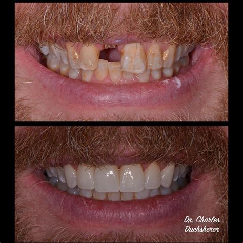 Replacing A Missing Front Tooth Cosmetic Dentistry Dentistry Dentist