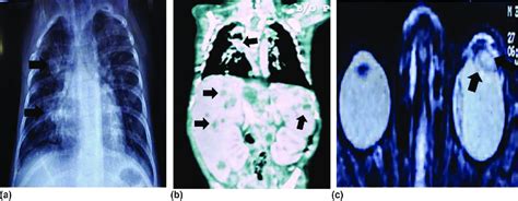 Chest Radiograph Showing Confluent Nodules In Both Lungs And Download Scientific Diagram