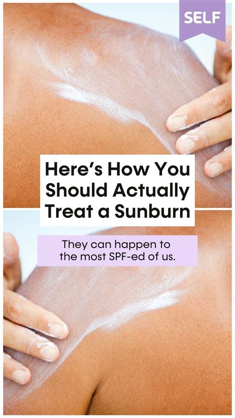 Heres How You Should Actually Treat A Sunburn Sunburn Pain Relief
