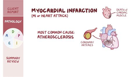 Myocardial Infarction Mi Nursing Process Adpie Osmosis Video Library